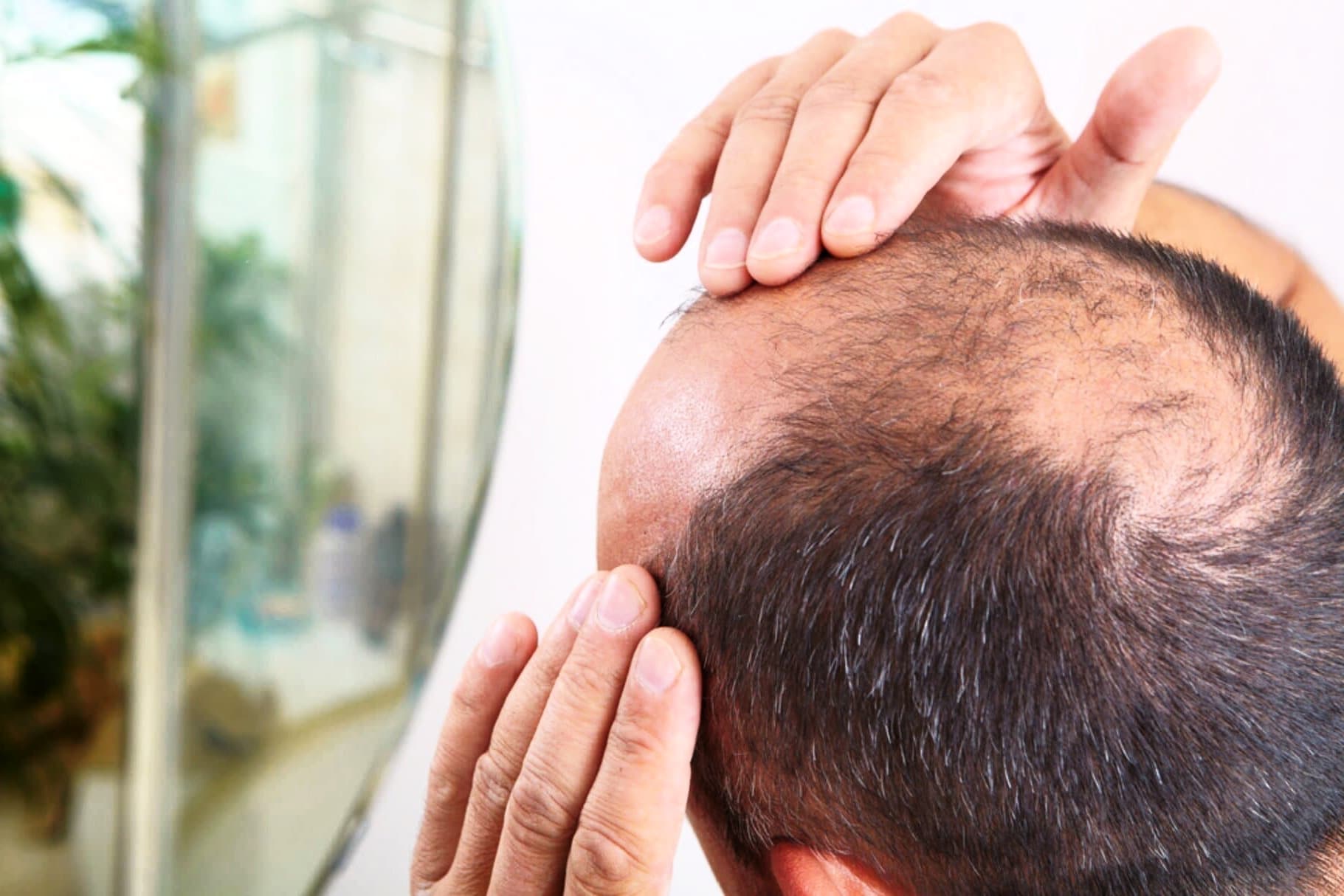 Hair Loss Treatments for Men | Male Hair Loss Treatment